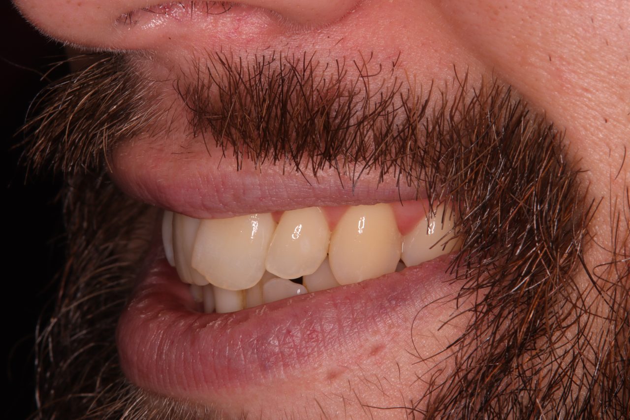 Invisalign Droitwich | Clear Aligners for Straight Teeth