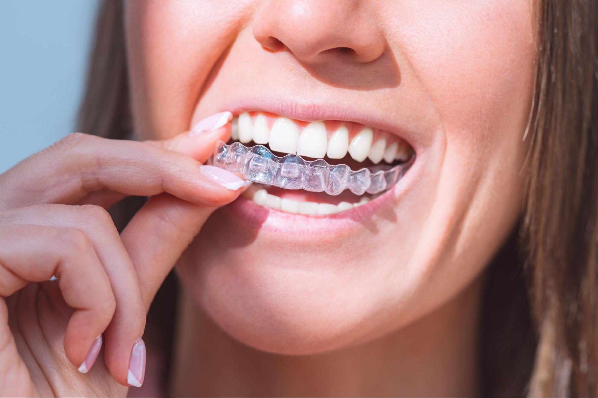 How Long Does Invisalign Take to Work? | Invisalign Droitwich